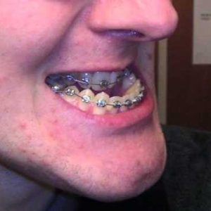 Prognatismo - O que é, conceito e definição