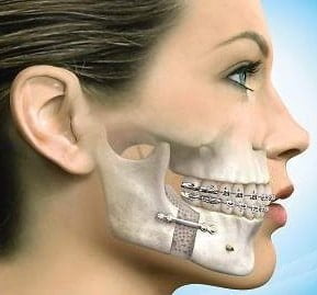 Queixada - O que é, conceito e definição