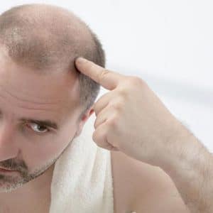 Calvície - O que é, conceito e definição